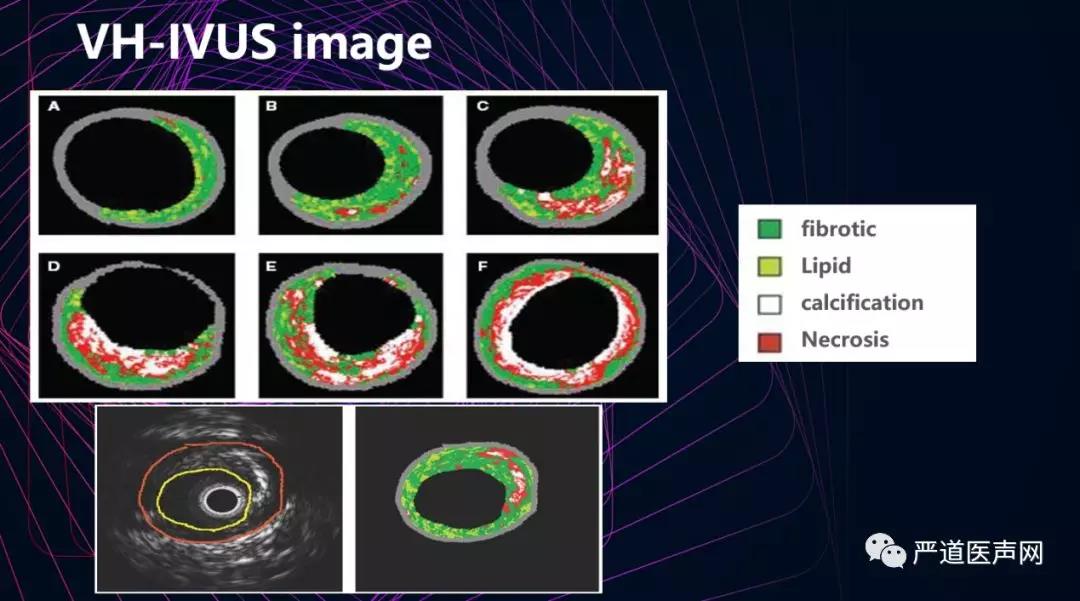 美国C3｜刘巍：IVUS的影像解读和测量 -- 严道脑血管网