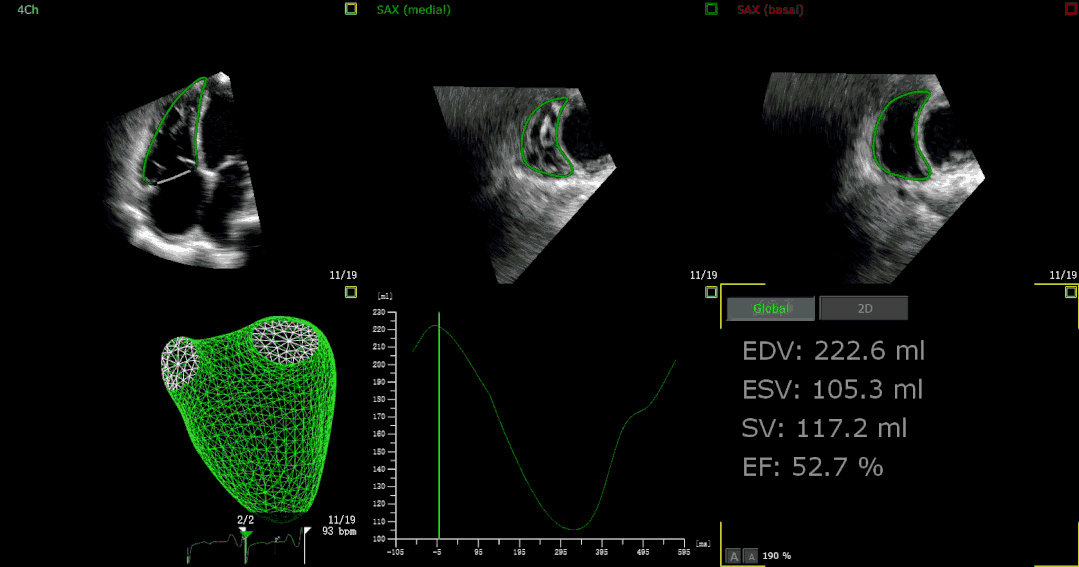 飞声悦览｜全自动三维超声心动图评价右室射血分数的预后价值：右室为主切面和心尖四腔心切面分析的直接比较 -- 严道脑血管网