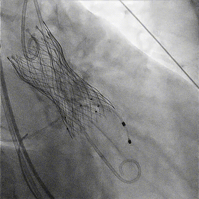 厦心王焱教授团队成功完成福建首例（全国第二例）经腔静脉TAVR -- 严道脑血管网