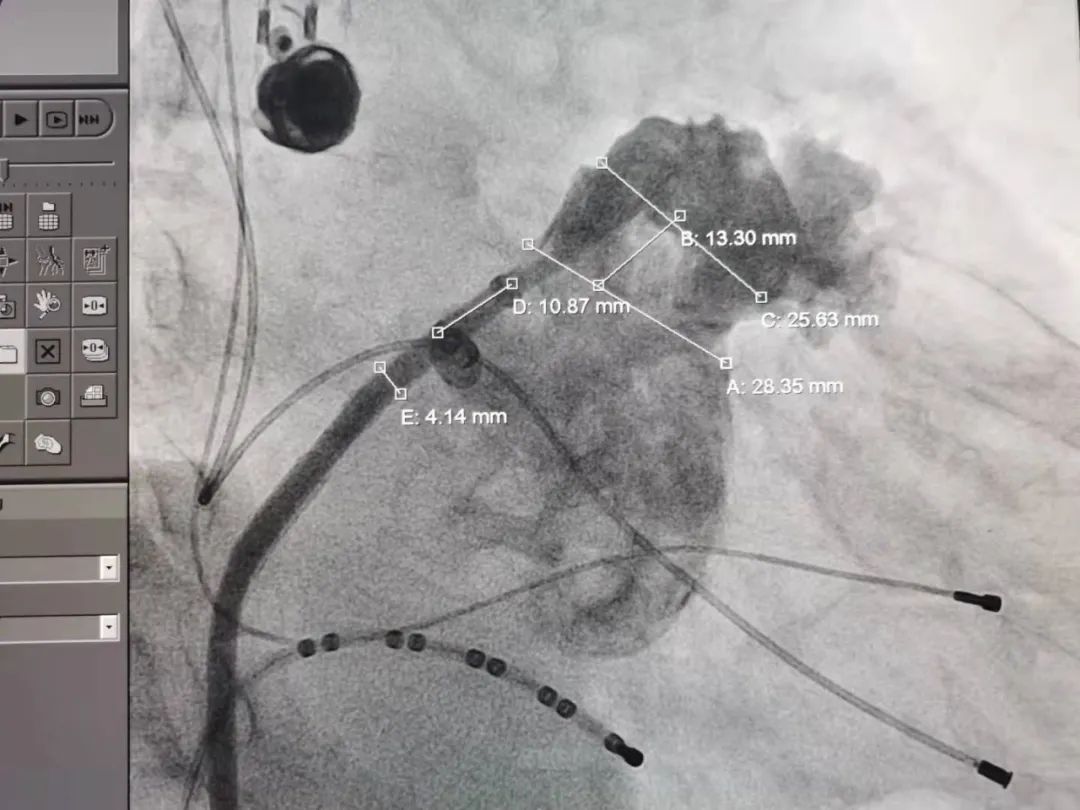 LAAC开启可调弯时代丨珠海市人民医院成功完成LAnavi™分段控弯导引系统上市后首例正式入院使用！ -- 严道脑血管网
