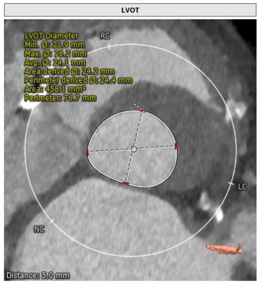 全球首例！董念国、吴永健、彭小平教授三方团队成功完成Leaflex™ Performer联合TriGUARD3™人体应用 -- 严道脑血管网