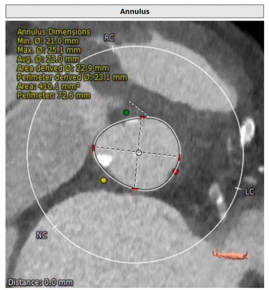 全球首例！董念国、吴永健、彭小平教授三方团队成功完成Leaflex™ Performer联合TriGUARD3™人体应用 -- 严道脑血管网