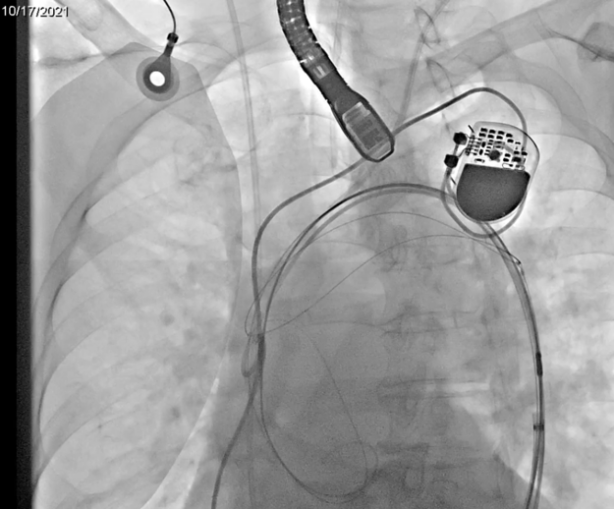 全球首例！董念国、吴永健、彭小平教授三方团队成功完成Leaflex™ Performer联合TriGUARD3™人体应用 -- 严道脑血管网