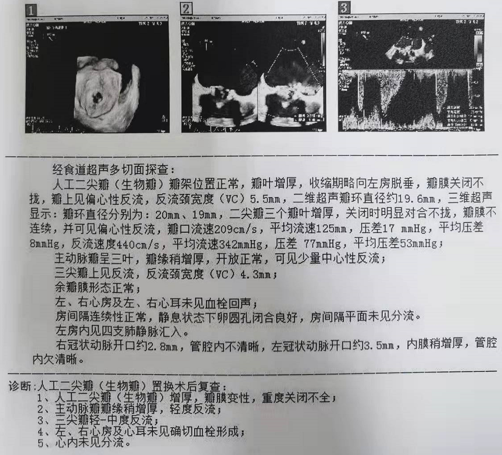 新选择续航“心”能力：重庆新桥医院晋军、于世勇教授团队首次应用SAPIEN 3瓣膜¹系统成功挑战经股静脉途径ViV-TMVR手术 -- 严道脑血管网