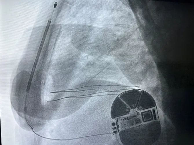 新疆自治区中医医院成功植入本院首例全皮下植入式心律转复除颤器(S-ICD) -- 严道脑血管网