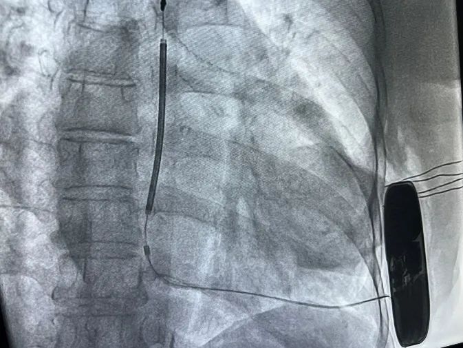 新疆自治区中医医院成功植入本院首例全皮下植入式心律转复除颤器(S-ICD) -- 严道脑血管网